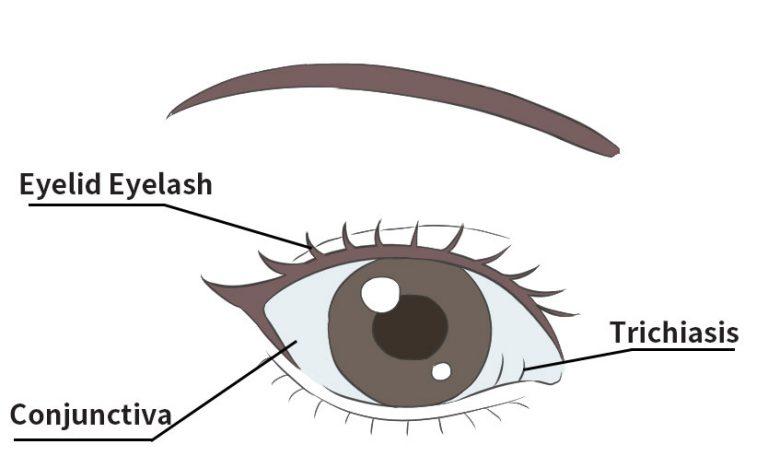 Trichiasis: Causes, Treatment, Postoperative Care - A professional ...
